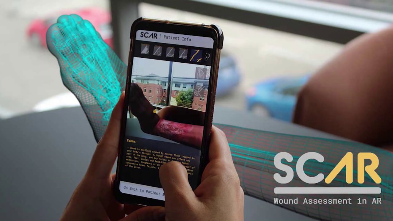 SCAR | Wound Assessment in Augmented Reality - YouTube