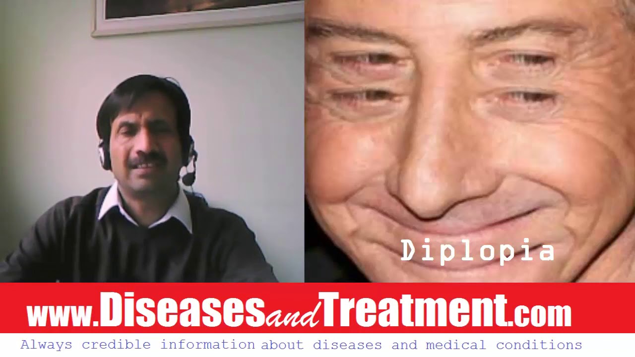 26# Diplopia Double Vision Causes, Diagnosis, Symptoms, Treatment ...