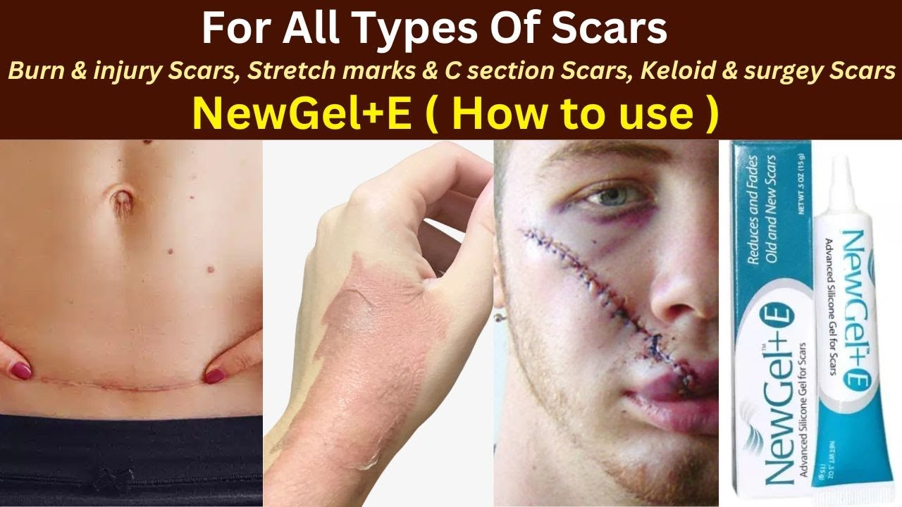 Newgel+e how to use | newgel for acne, burn, keloid, surgery scars ...
