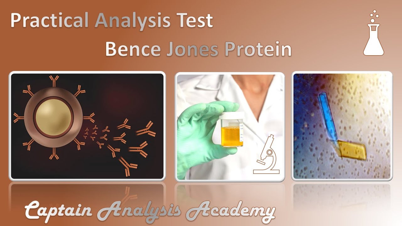 E14. Bence Jones Protein من تحليل البول اقدر اعرف نوع السرطان اذاى ...