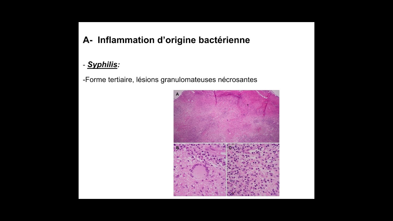 aspects anatomo et cytopathologiques des infections anapath - YouTube