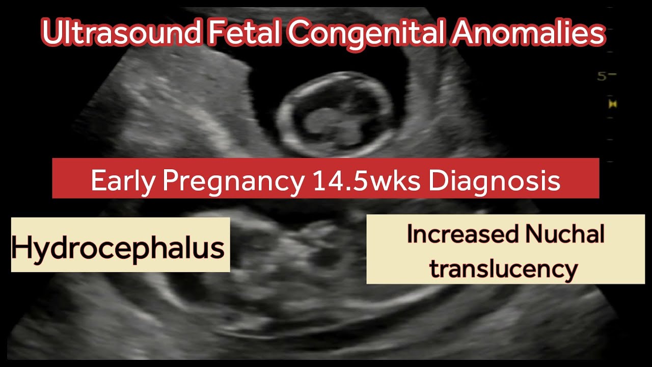 14+wks Early Pregnancy , Ultrasound Fetal Hydrocephalus + Increased ...
