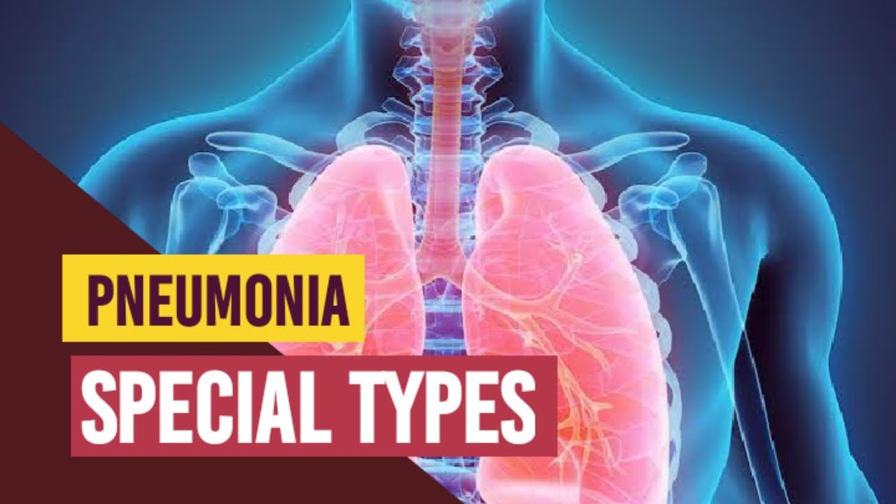 icu chest (10) pneumonia | special types + pneumonia in ...