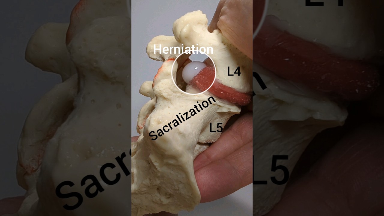 Disc Herniation Model with Lumbosacral Transitional Vertebrae. - YouTube