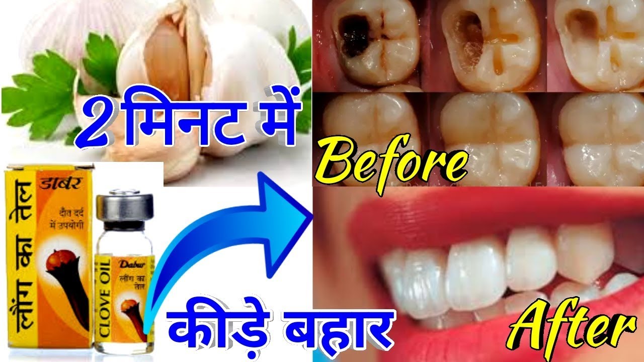 Daat me kida | दांत का कीड़ा और दर्द बाहर निकालने का बेहतरीन उपाय - How ...