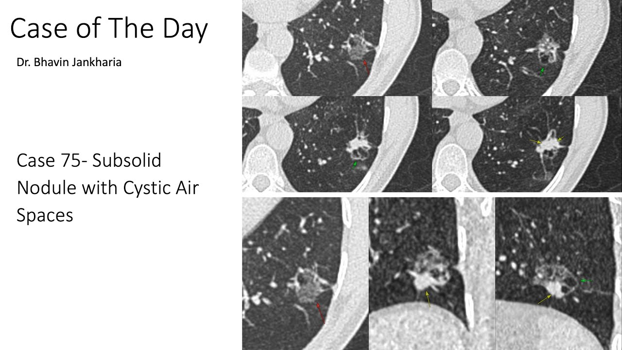 Case of the Day - 075 - 2025 07 24 - Subsolid Nodule with Cystic Air ...