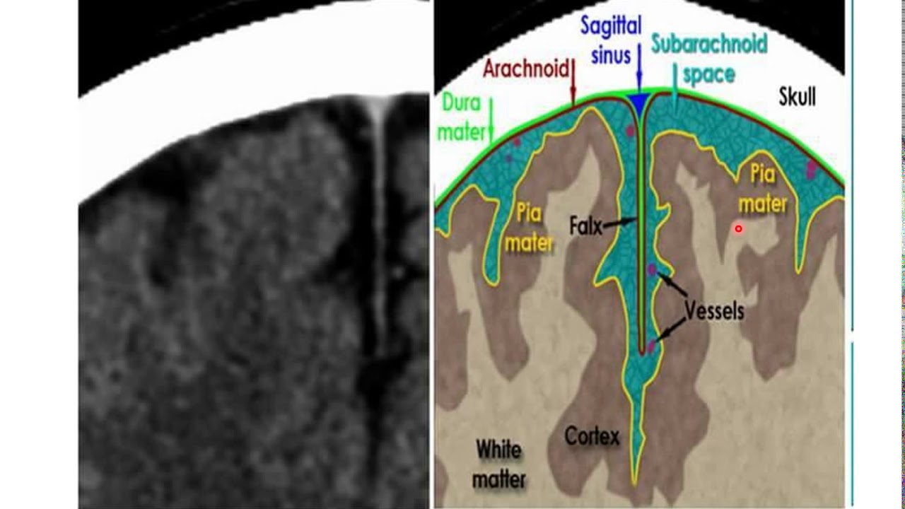 Basics of brain CT scan part I - YouTube