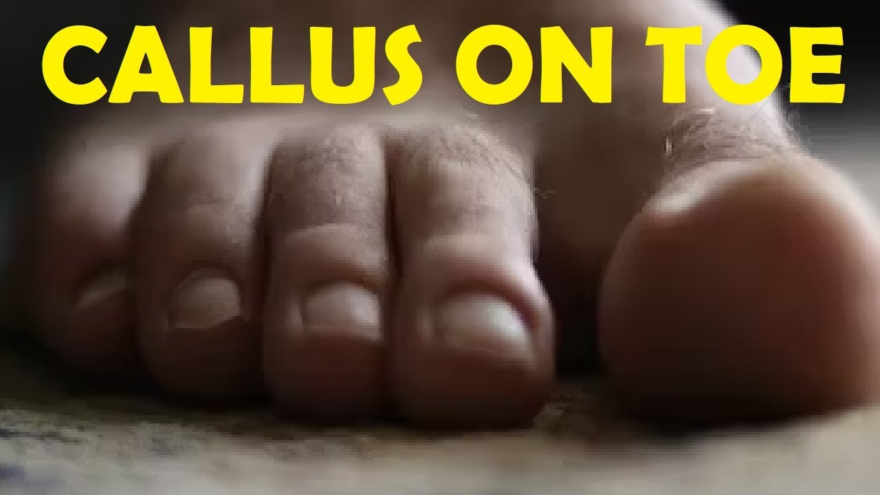 how to get rid of calluses on your toes - YouTube