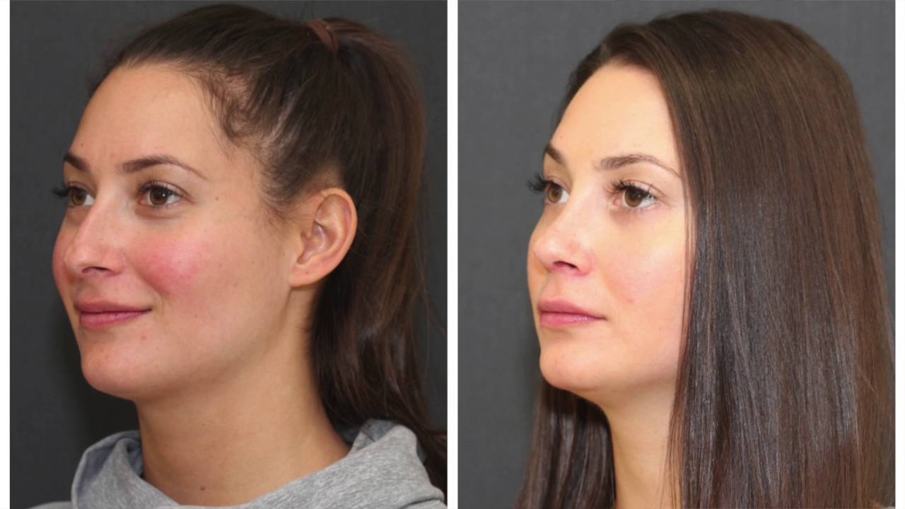 Rhinoplasty - 1 Month Follow Up! - YouTube