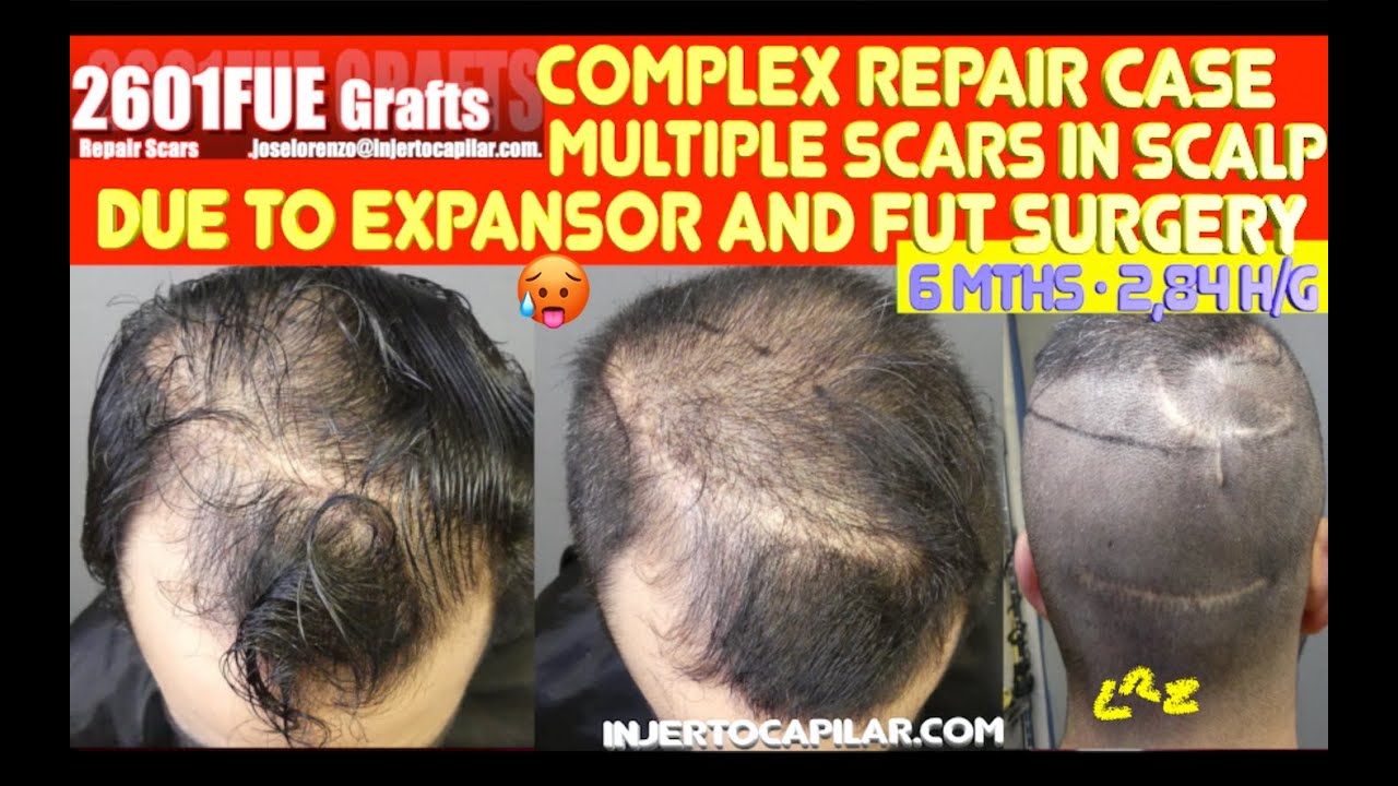 2601Grafts. Complex repair w/multiple scars due to expansor and FUT ...