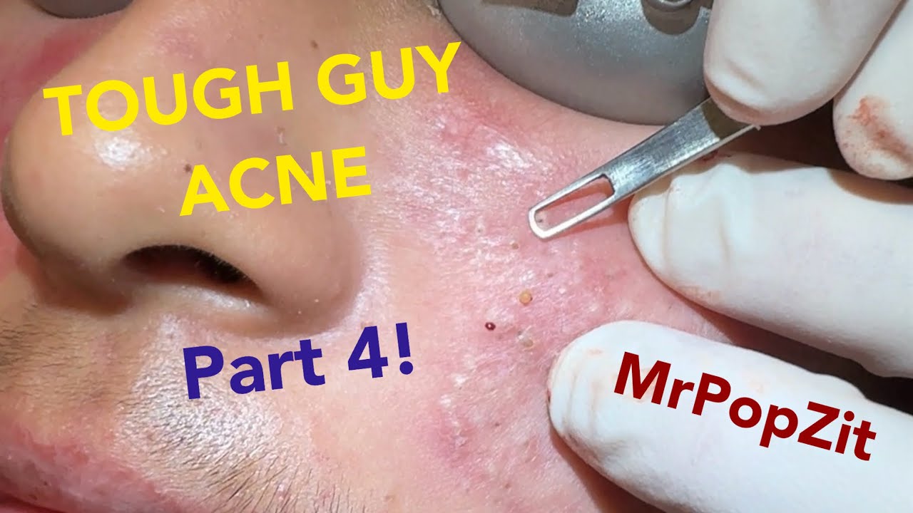 Tough Guy Acne part 4!Acne extractions.Make an appointment with me ...