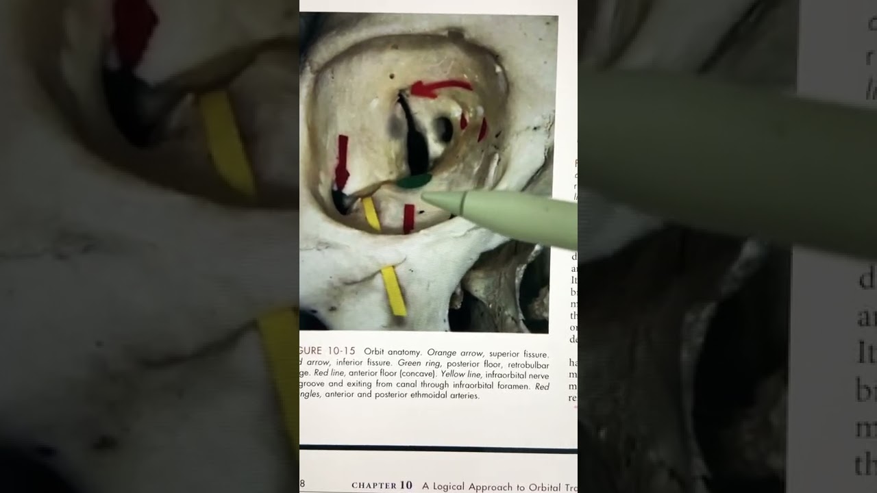 Hypoglobus vs Enophthalmos #maxillofacialsurgery #maxillofacialsurgeon ...