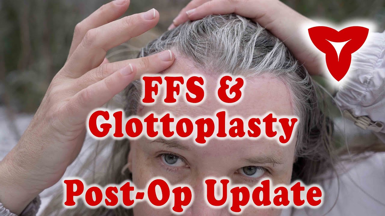 Post-Op Day 44 Facial Feminization Surgery — 1 Month Post-Op for Trans Glottoplasty — FFS Part ...