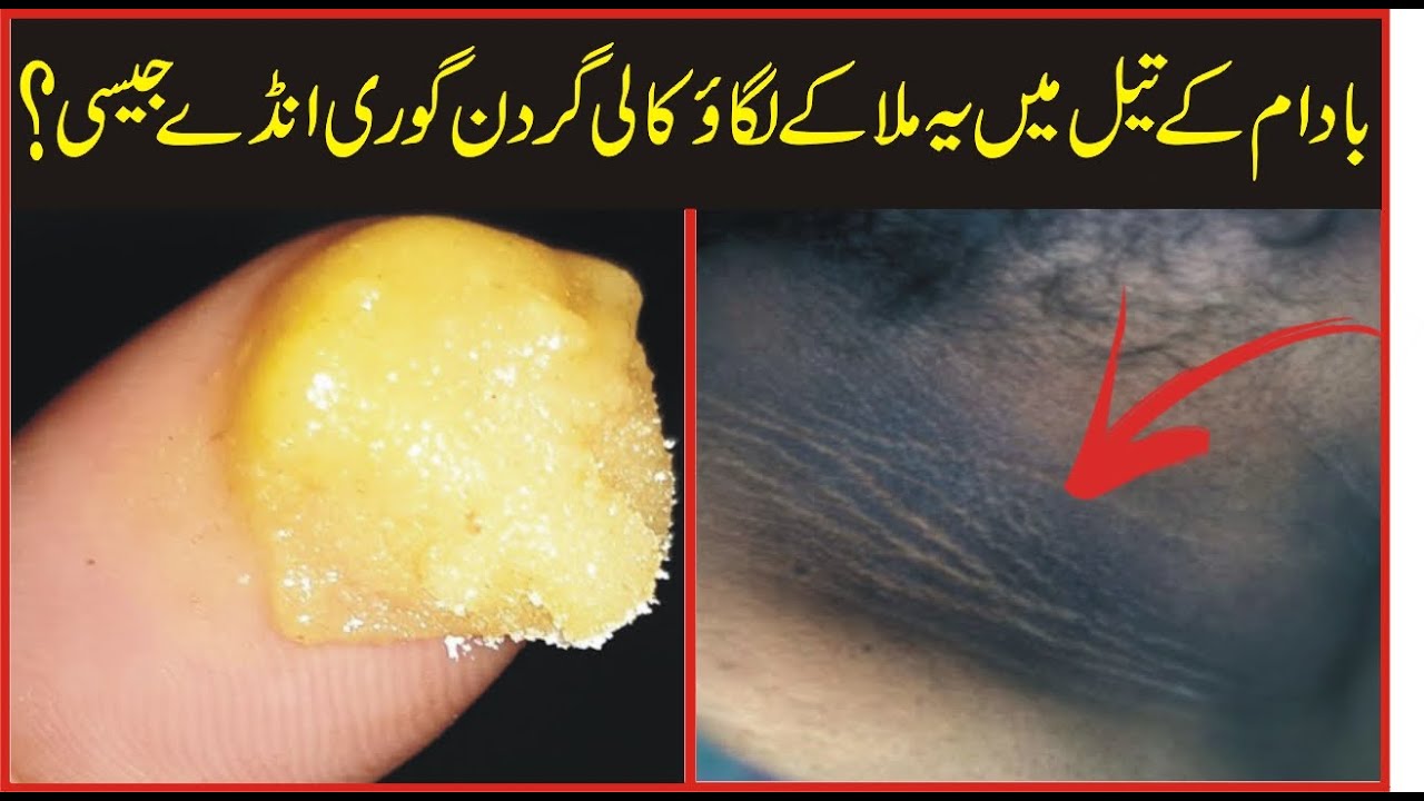 How To Get Rid Of Dark Neck Fast Home Remedy | Black Neck Removal Cream ...