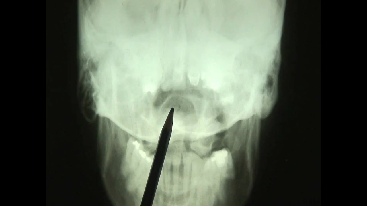 Upper Cervical X-ray Analysis Webinar part 1 -10 14, 2010 - YouTube