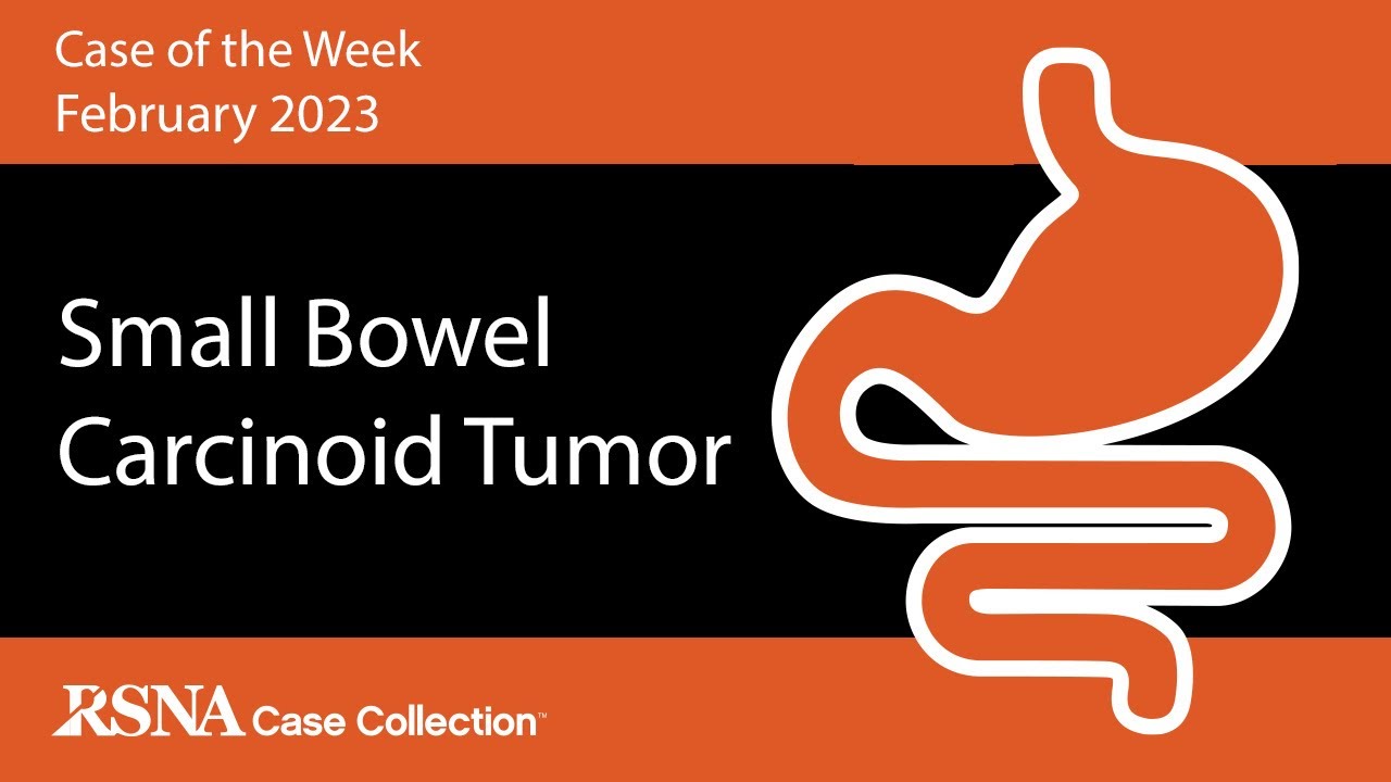 Case of the Week: Small Bowel Carcinoid Tumor - YouTube