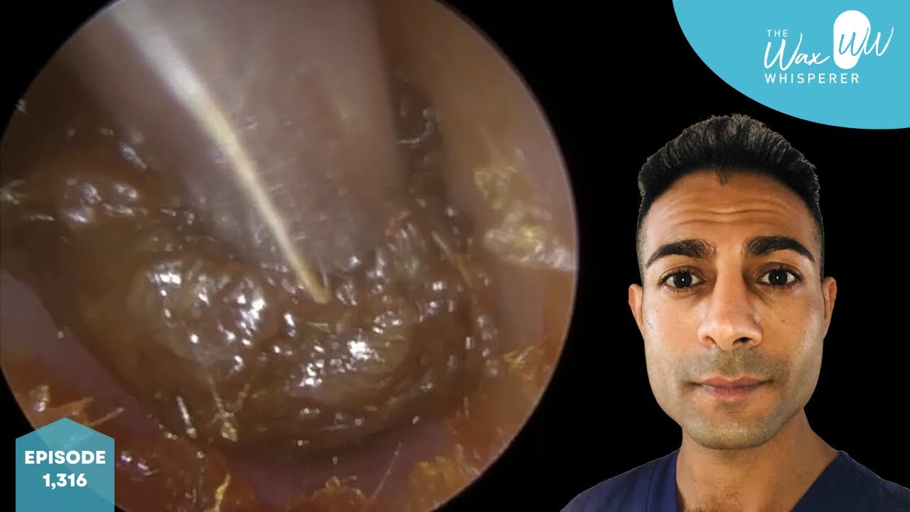 1,316 - Squashed-In Ear Wax with Q-tip Removed - YouTube