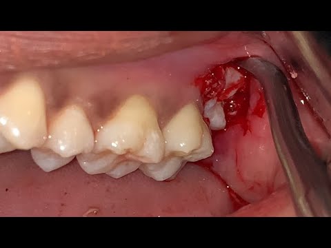 CABUT GERAHAM BUNGSU ATAS KIRI | Dentist | Dokter Gigi Tri Putra - YouTube
