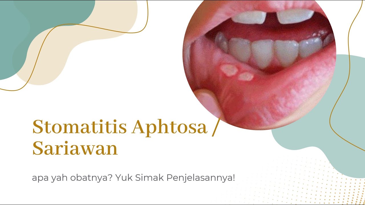 Stomatitis Aphtosa / Sariawan | apa yah obatnya? Yuk Simak Penjelasannya! - YouTube