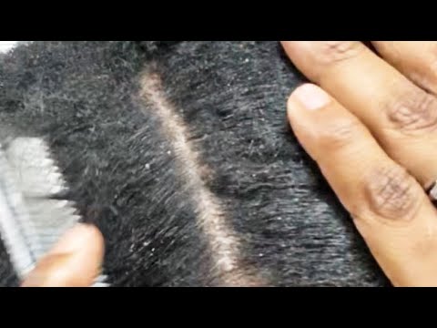 DANDRUFF SCRATCHING | Dry Itchy Scalp | Searching for snow Flakes 🔇 ...