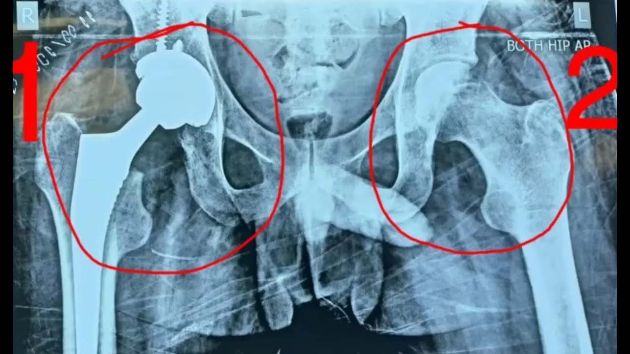 life transformation after Total Hip Replacement surgery at Young Age ...