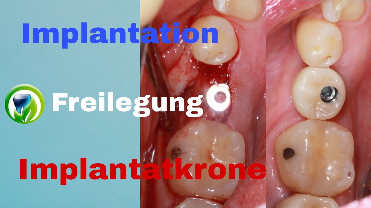 Zahnimplantation, Freilegung, Abformung, Implantatkrone - Ablauf ...