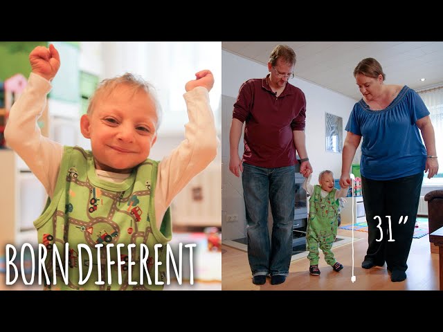 Microcephalic Osteodysplastic Primordial Dwarfism Type Ii