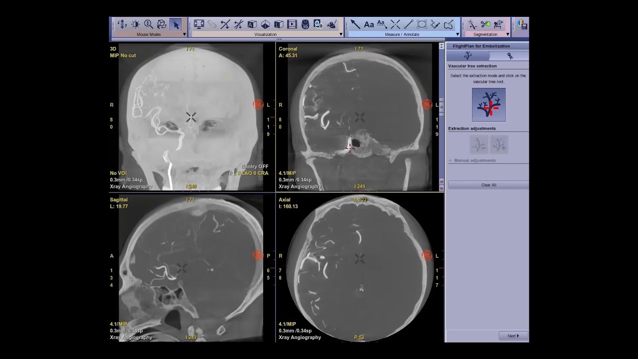 Embo ASSIST solution by GE Healthcare - European premiere! - YouTube