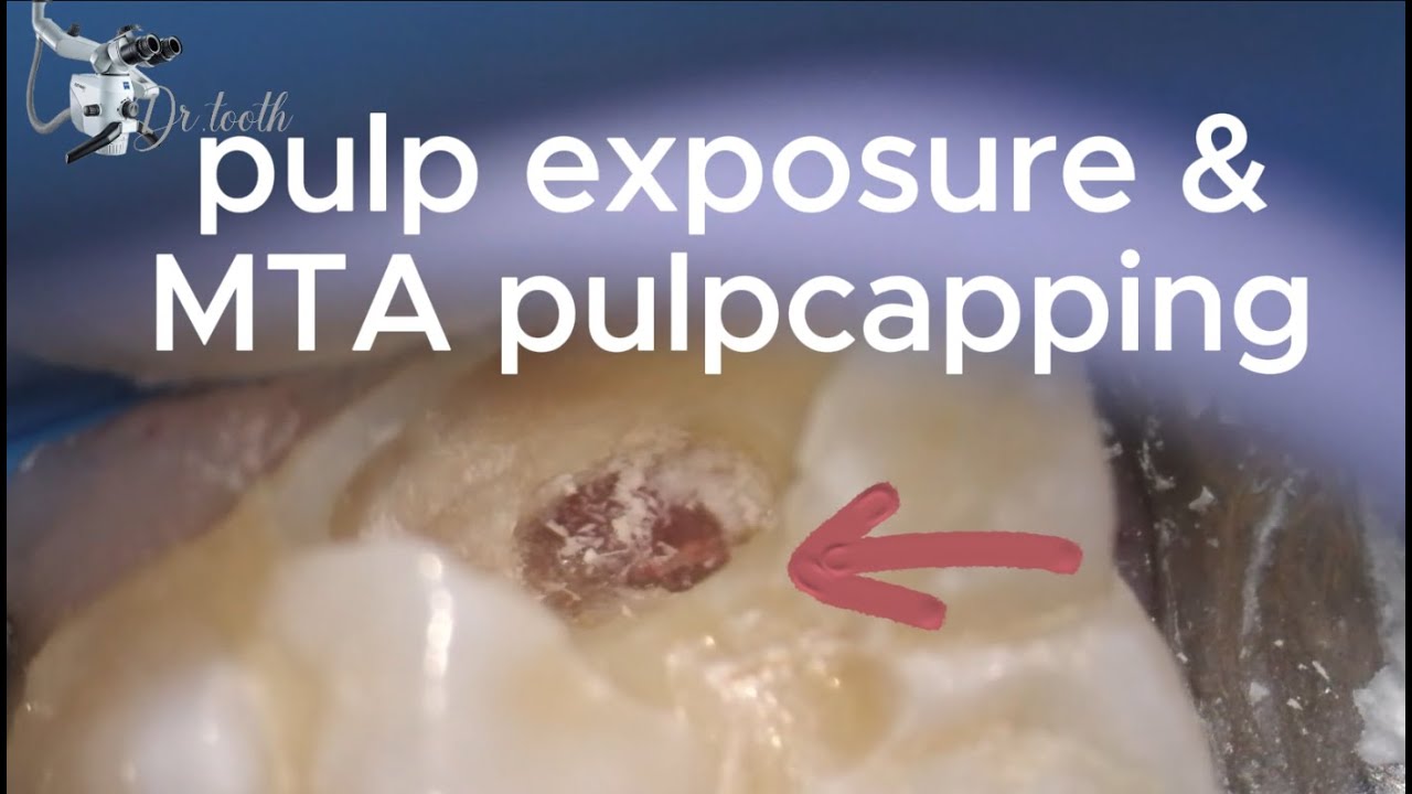 Pulp exposure and MTA pulp capping in E-max inlay prep case (MTA 치수복조 ...