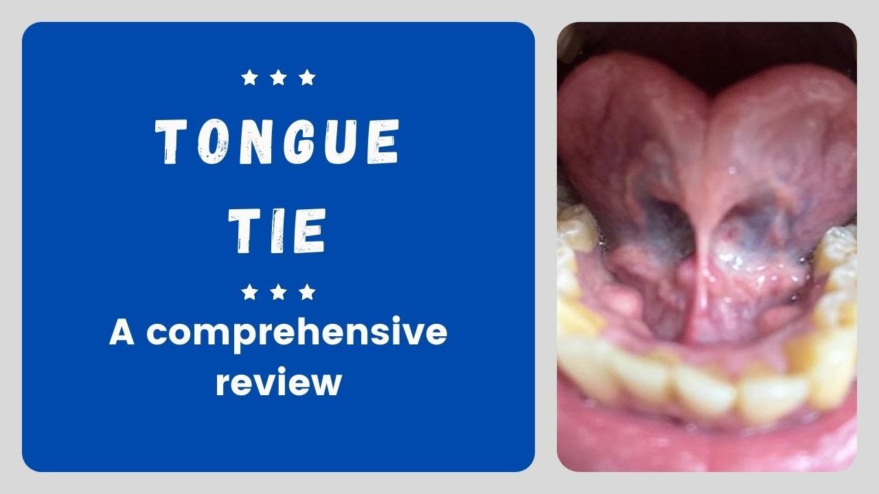 Tongue-tie a comprehensive Review | Ankyloglossia - YouTube