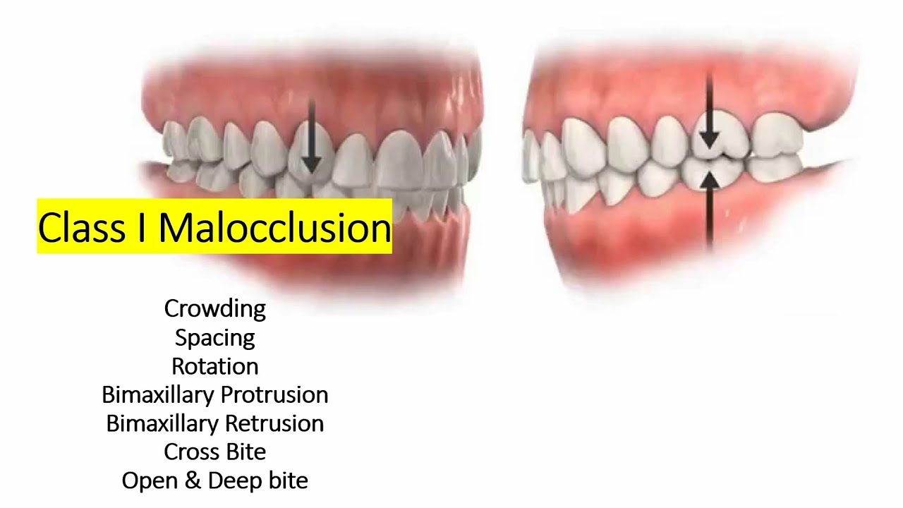 NEET MDS# Class 1 Malocclusion | Types, Causes &Treatment . Dental ...