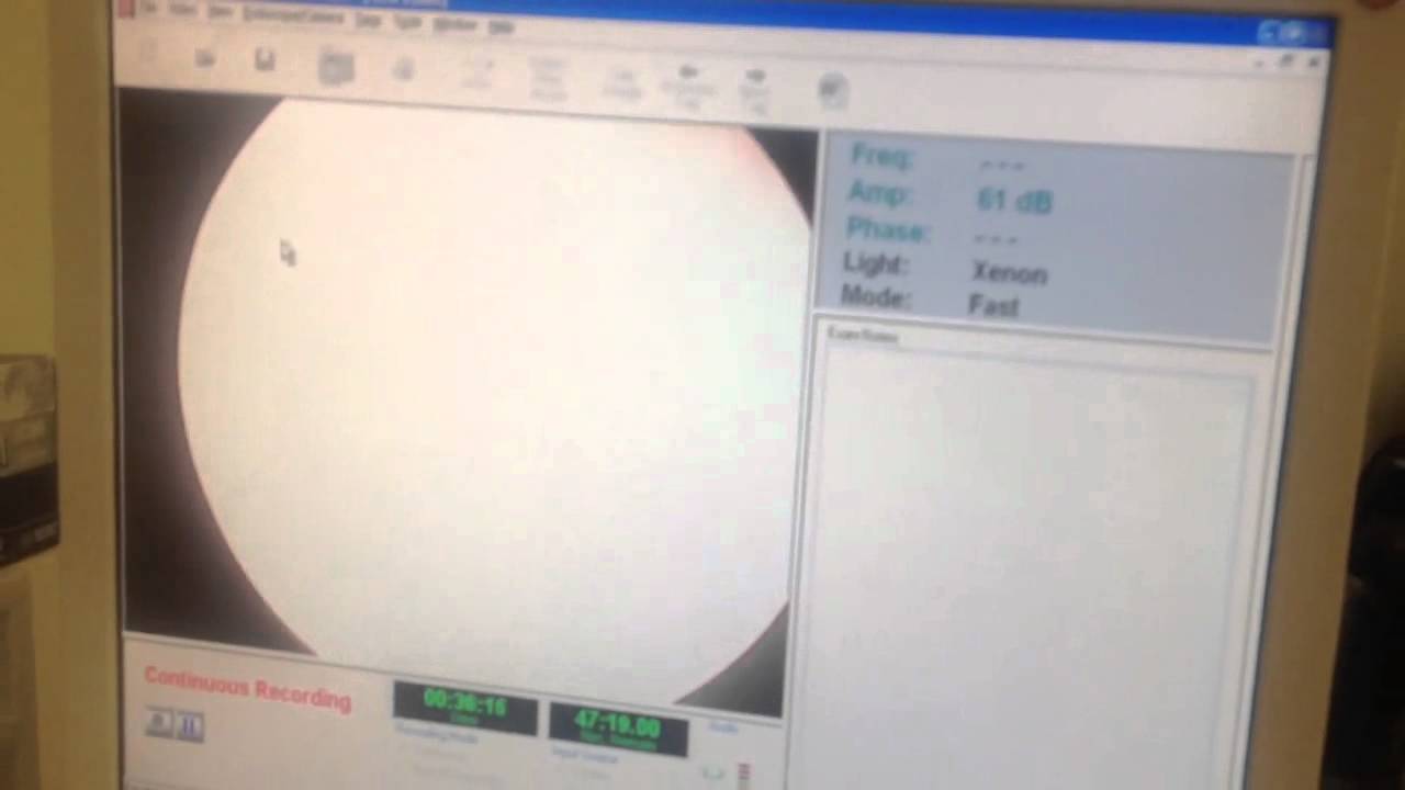 Spencer Craven's Vocal Cord Scope - YouTube
