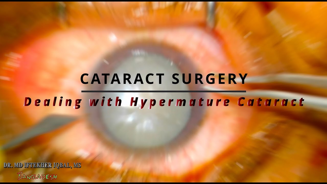 MIIQ 71: Cataract Surgery || Hypermature WHITE Cataract and PHACO || DR ...
