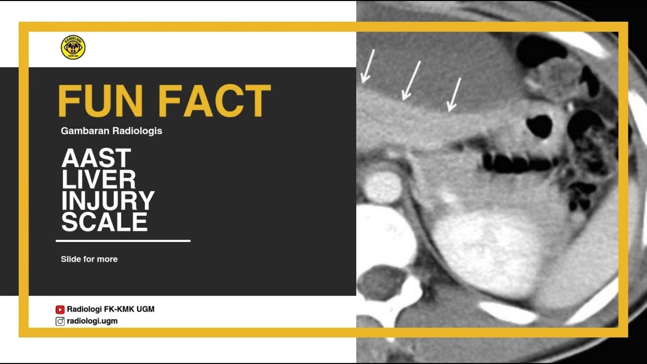 AAST Liver Injury Scale - YouTube