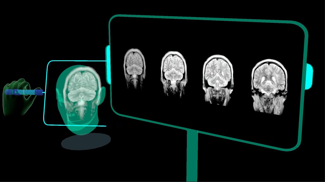 Lenovo Thinkreality A3 Glasses - Beenoculus MRI Slices AR viewer - YouTube