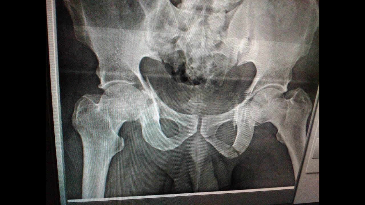 Acetabulum Percutaneous technique - Dr Ramprasad K MS(ORTHO) AIIMS ...