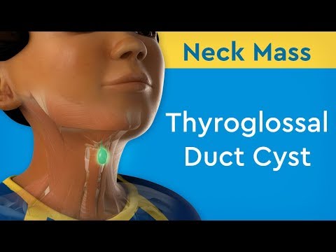 Neck Mass: Thyroglossal Duct Cyst