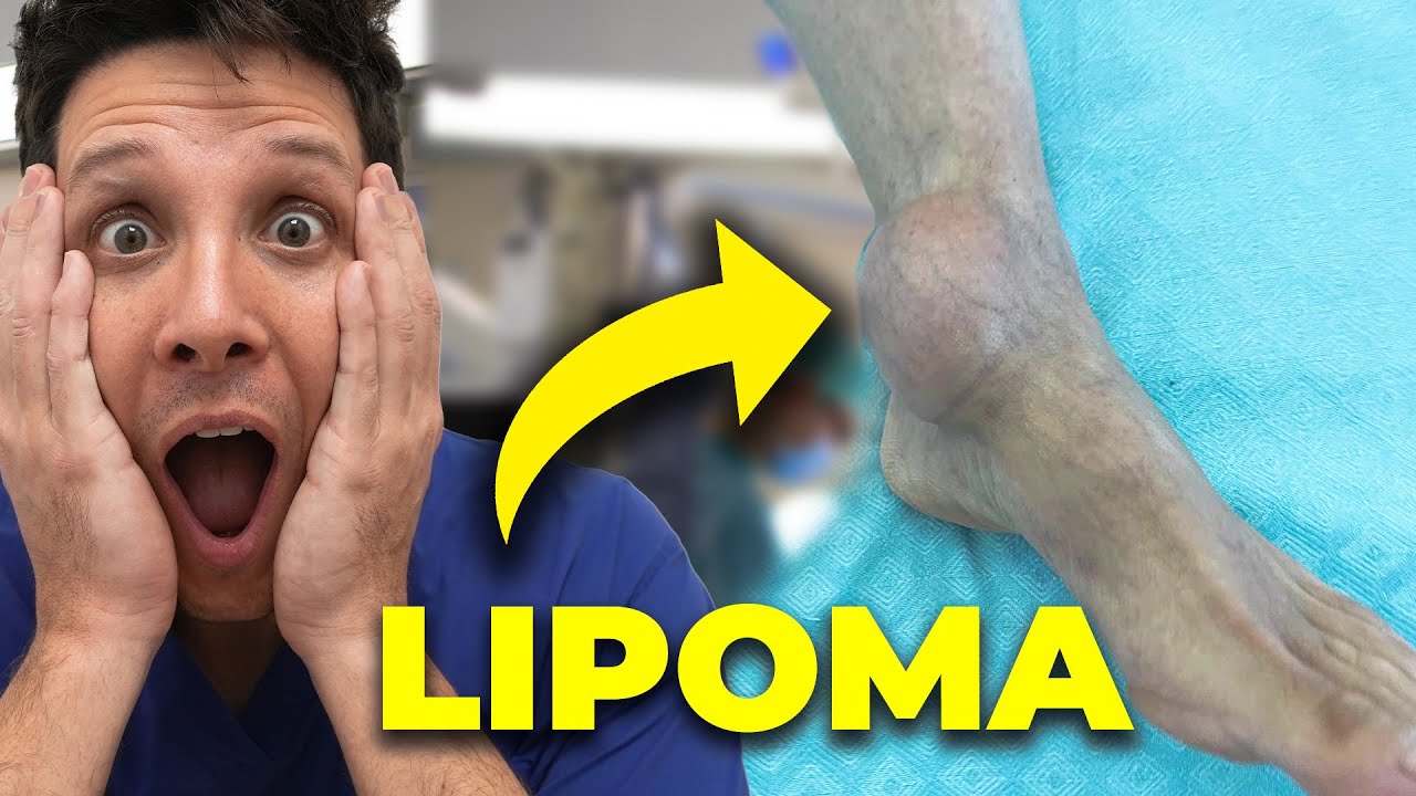 IL LIPOMA PIÙ GRANDE DELLA MIA VITA 😱 | Dott. Claudio Maestrini - YouTube