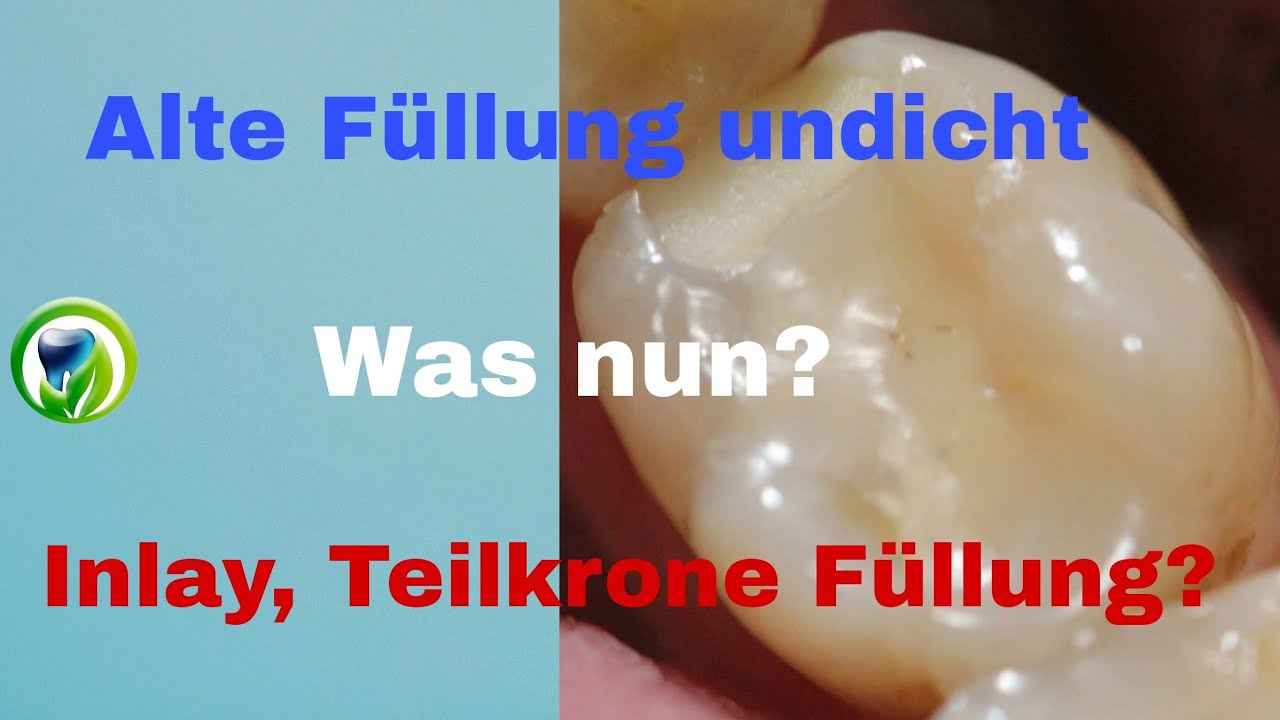 Inlay Teilkrone Füllung - Vollkeramik | Gold | Komposit | Adhäsivsystem ...