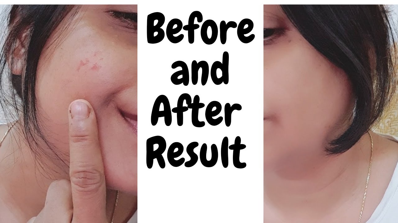 L'Oréal Paris Glycolic Bright Range 2 Weeks Review with Before & After ...