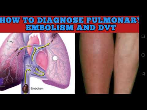 HOW TO DIAGNOSE PULMONARY EMBOLISM AND DEEP VENOUS THROMBOSIS - YouTube
