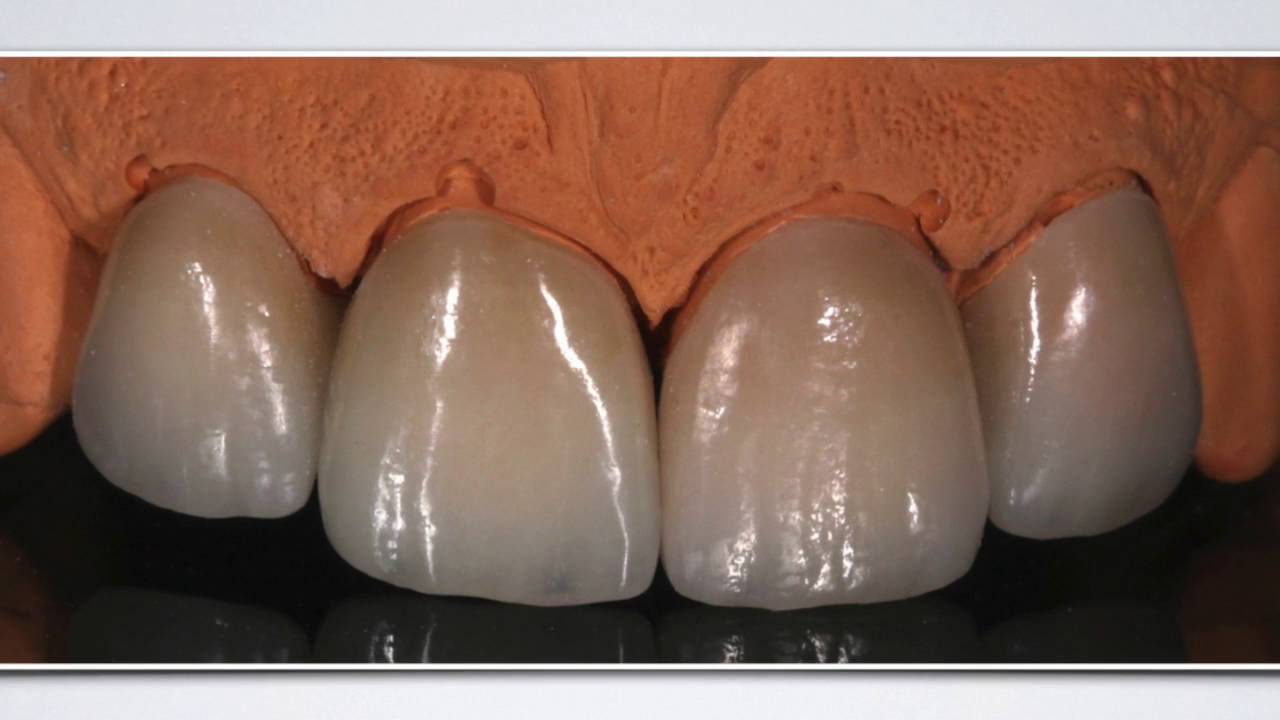 adhesive restoration of anterior four - YouTube
