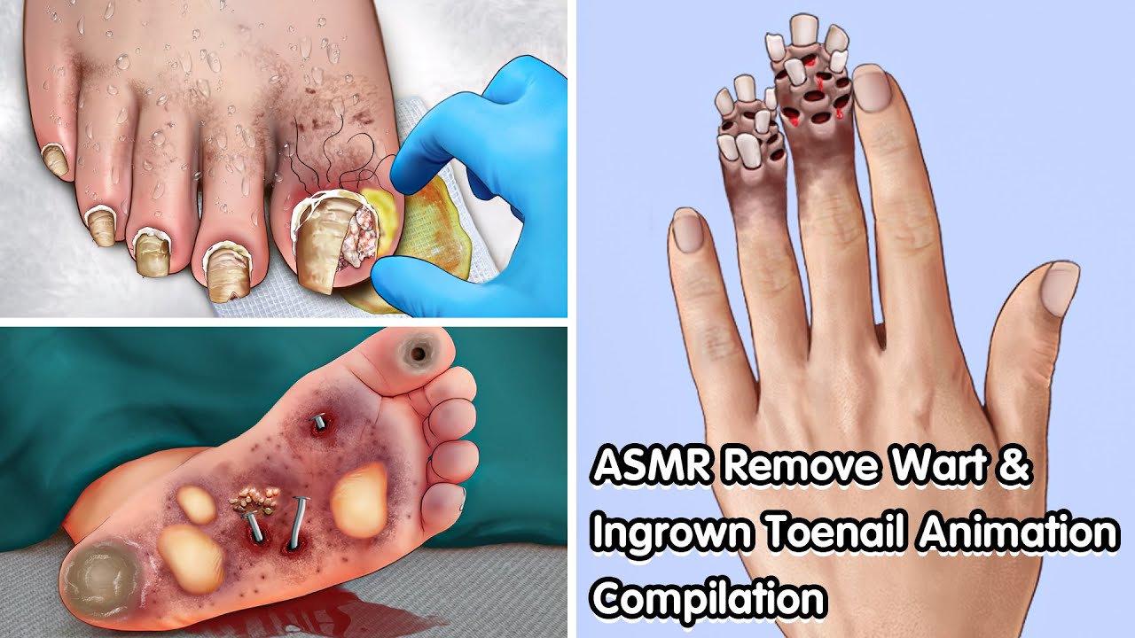 ASMR Remove Wart & Ingrown Toenail Animation Compilation - Deep ...