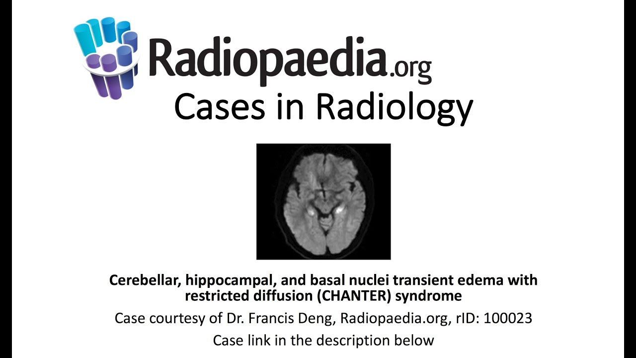 CHANTER syndrome (Radiopaedia.org) Cases in Radiology - YouTube