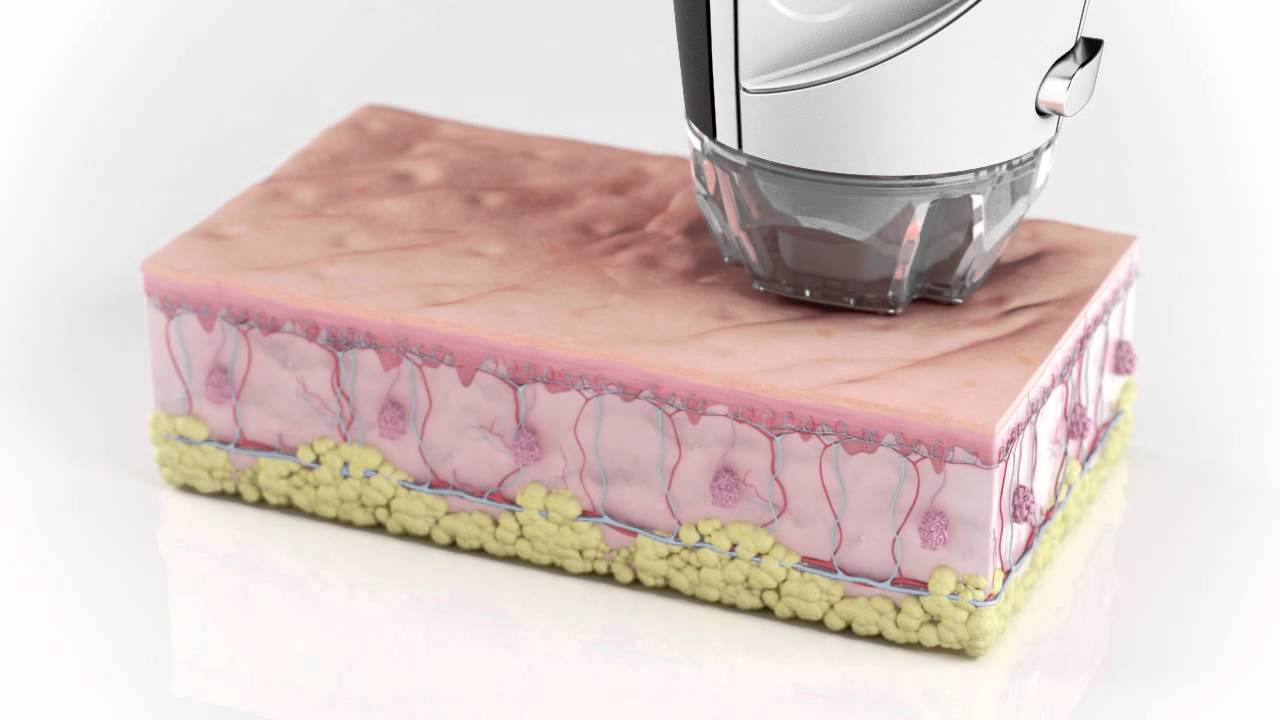 Healing Revolutions E-Matrix Skin Rejuvenation System - YouTube