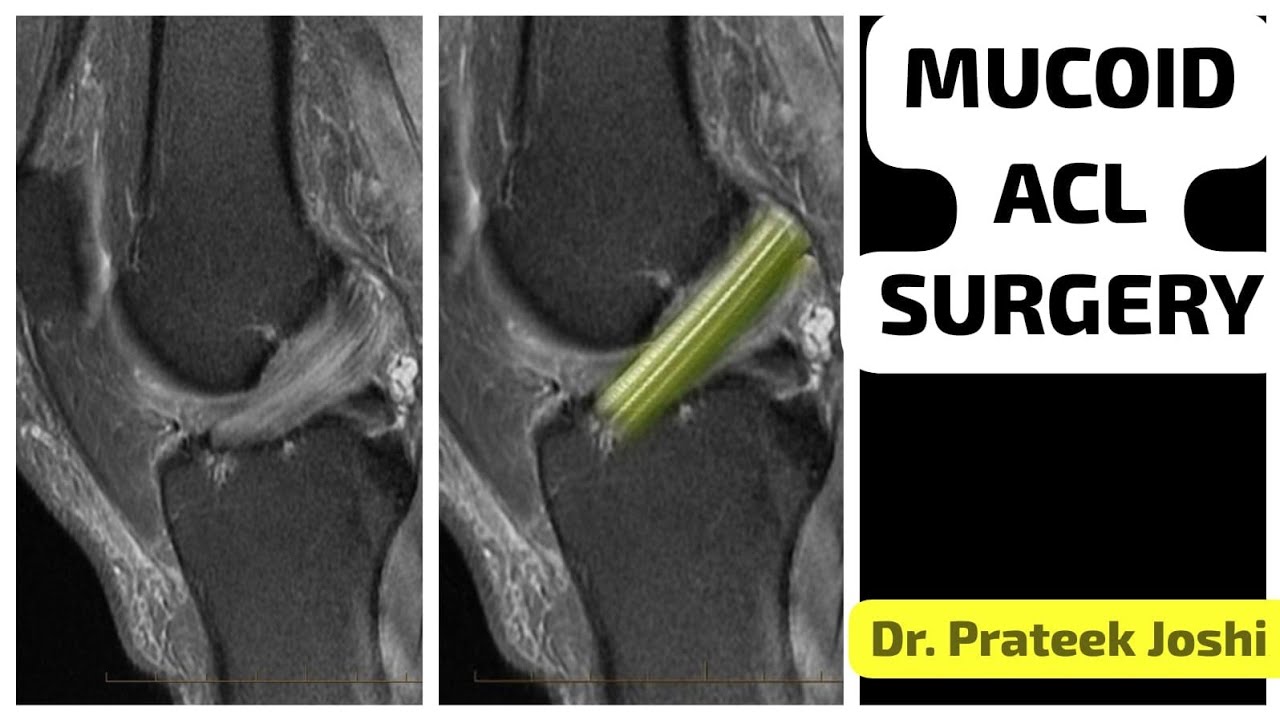 Mucoid Degeneration of ACL ligament | Arthroscopic Debulking of ACL ...