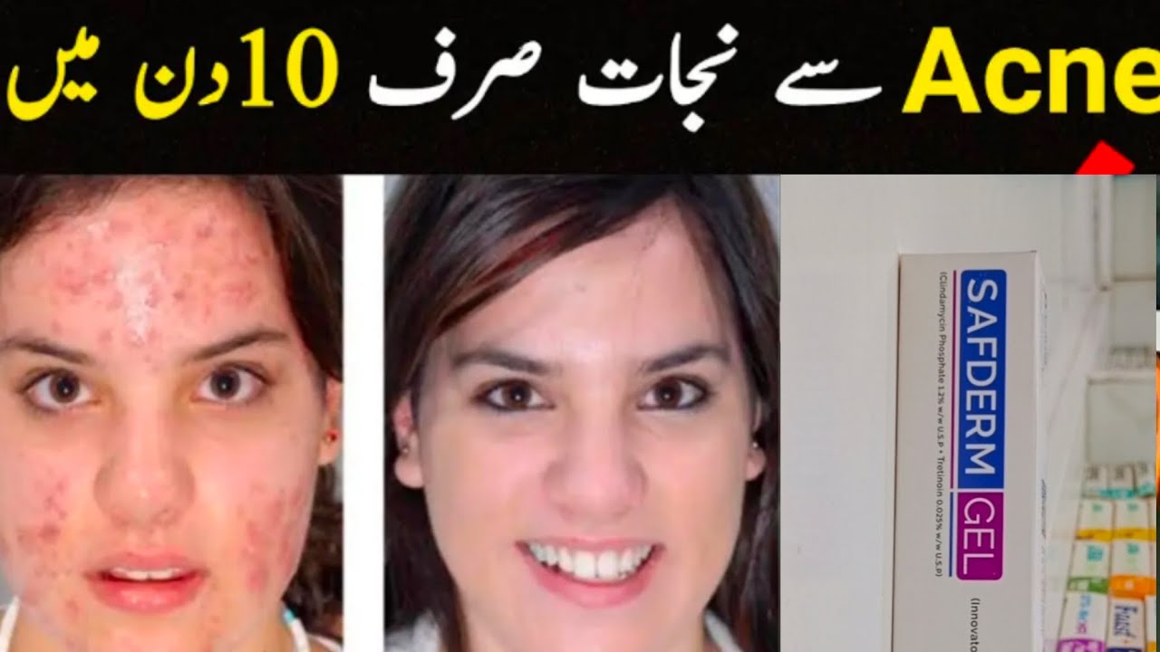 Safderm gel uses l best to stop acne & pimple from skin l bnft & effct ...