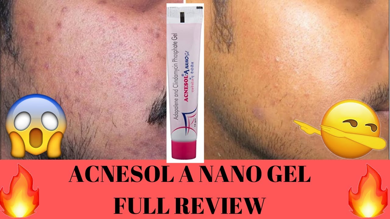 ACNESOL A GEL FULL REVIEW BEST FOR ACNE AND PIMPLES || कील मुहासे गायब ...