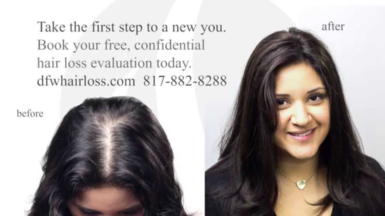 Before & After Dermal Lens-Vanessa - YouTube