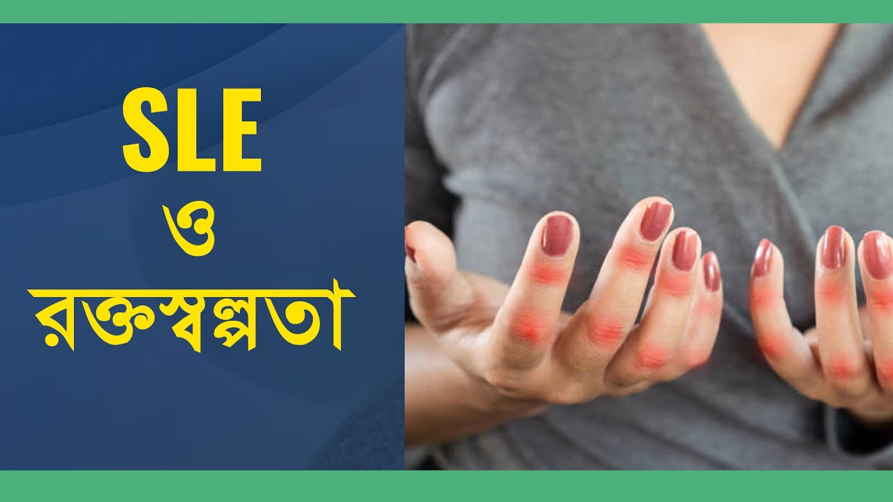 SLE Disease | SLE রোগে রক্ত স্বল্পতা ও চিকিৎসা | SLE Disease Bangla ...